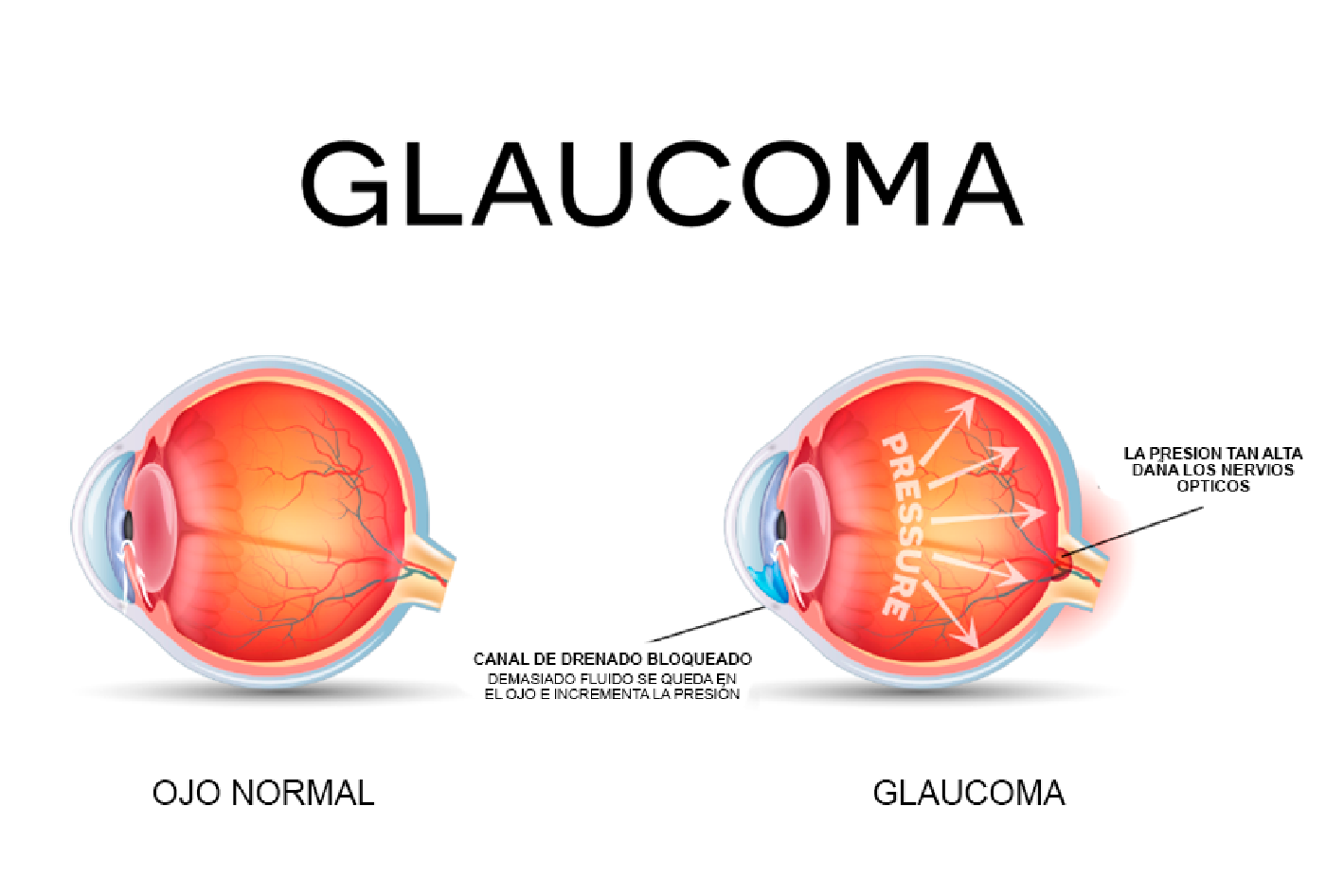 Glaucoma Centro Ofatalmológico San Ángel